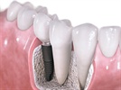 Astra Tech Restorative | Dentalcompare: Top Products. Best Practices.